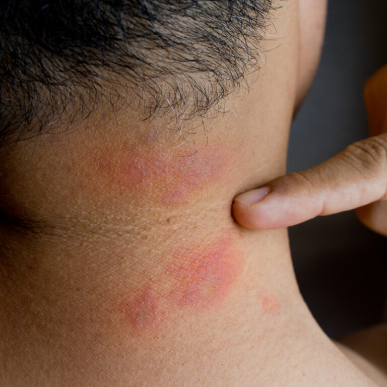 Doctors Warn Bali Travelers About Rash Caused By Contact With Toxic ...