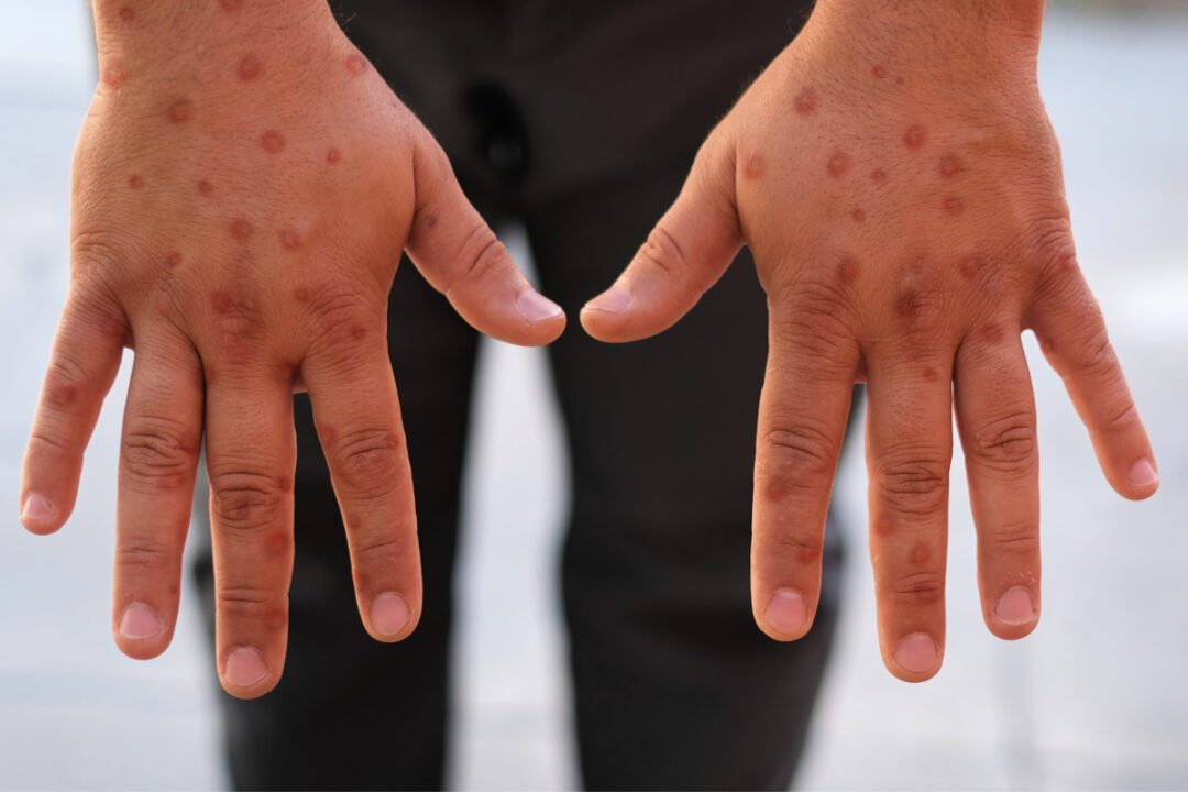 Bali Tourists Must Complete New Mpox Screening Protocol On Arrival ...